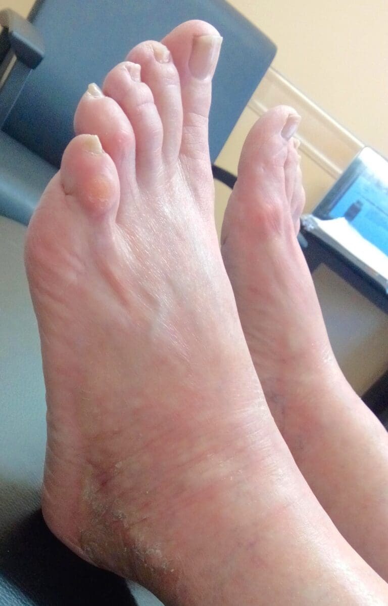 Morphea: Effective Treatment with Homeopathy